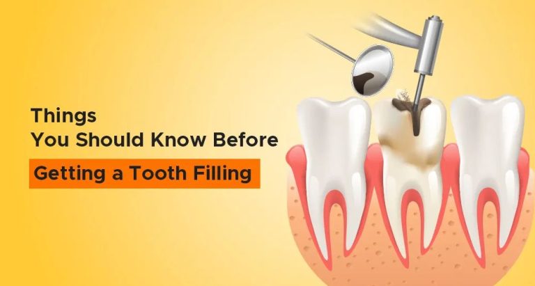 Dental Fillings Explained | Types, Durability and Modern Tooth-Coloured ...